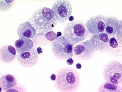 Bronchoalveolar lavage; Bronchial Lavage; Lung Lavage